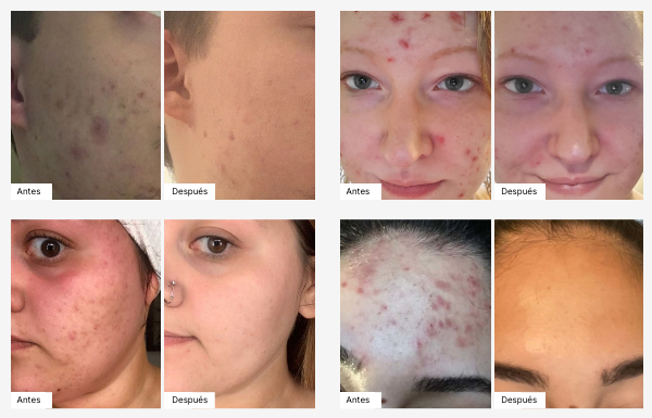 Almohadillas para el Acné con Ácido Salicílico de Neora Complexion ...