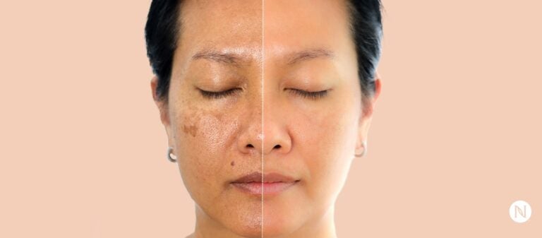 Understanding Sun Spots: Causes, Prevention, and Specific Treatments ...